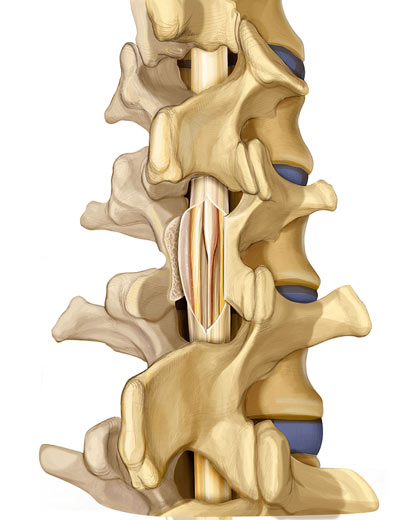 Selective rhizotomy for cerebral palsy - We help to pay your treatment