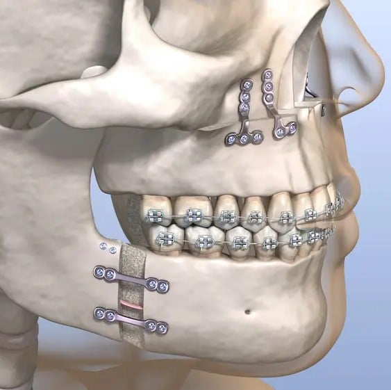 Double Jaw Surgery in Turkey ️ Prices and reviews