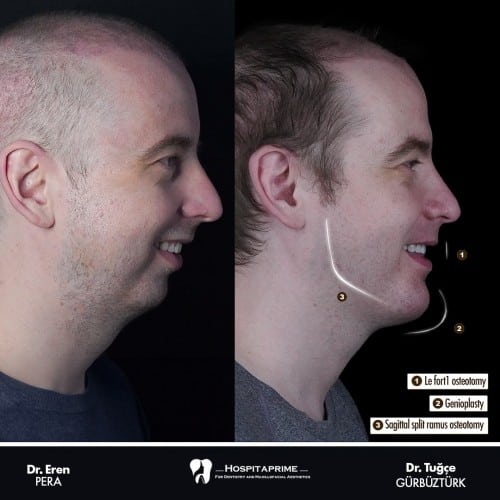 Double Jaw Surgery in Turkey ️ Prices and reviews