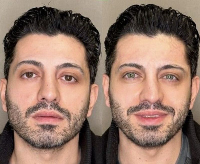 Keratopigmentation: Cost, Before & After Results, and Procedure Overview