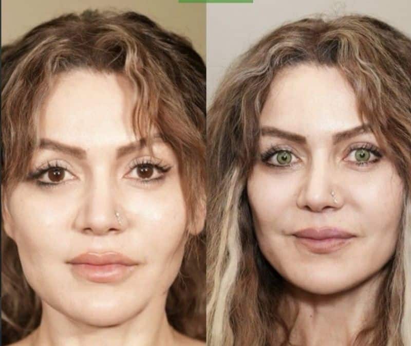 Keratopigmentation: Cost, Before & After Results, and Procedure Overview