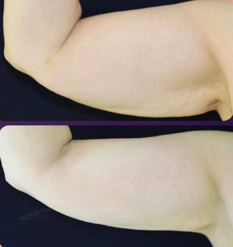 Arm lift in Turkey ️ Cost of arm lift in Turkey