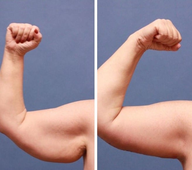 Arm lift in Turkey ️ Cost of arm lift in Turkey